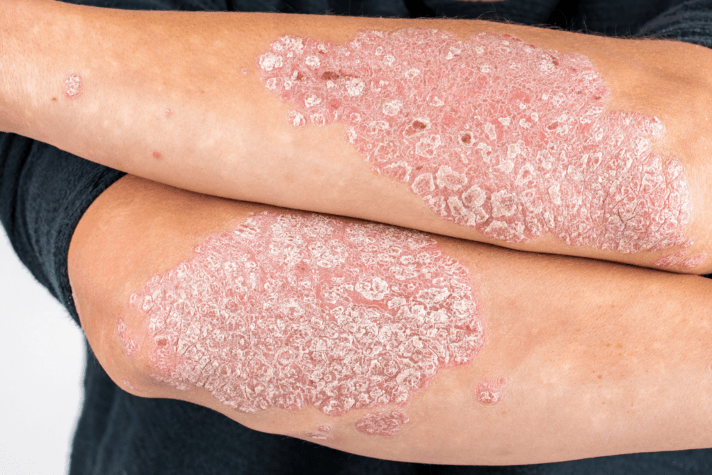 Psoriasis: Symptoms, Types, And Treatments